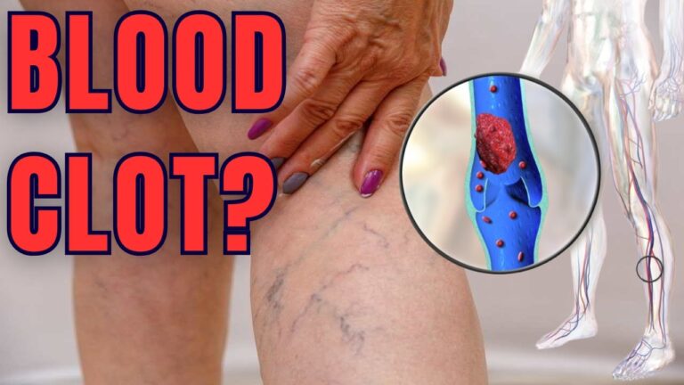 How to Identify a Blood Clot (DVT) in Your Leg